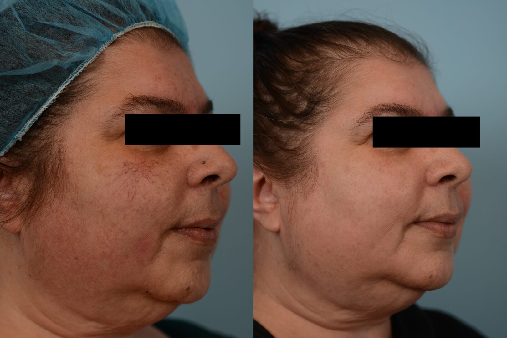 BBL Laser Facial in Portland, OR | BBL Facial Near Me