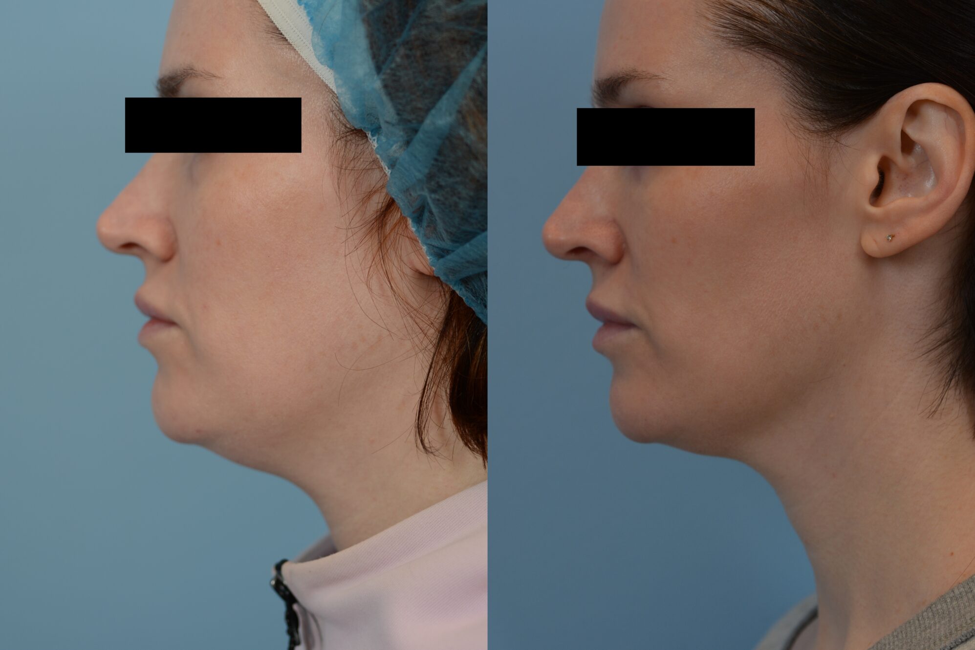 Ultherapy in Portland, OR | Ultrasound Facial | Key Laser Institute