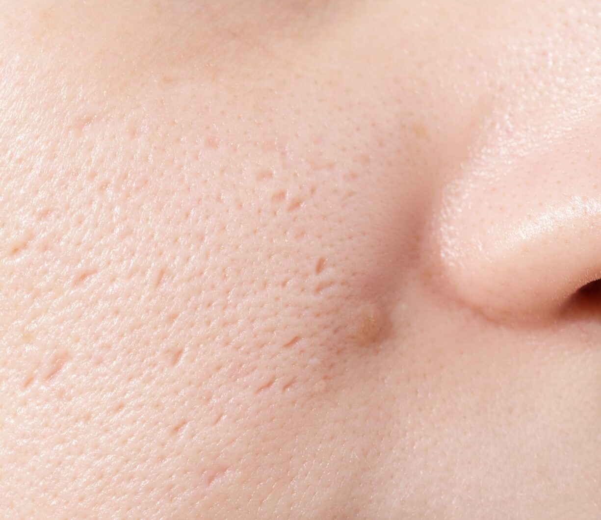 Skin Texture Treatment in Portland, OR | Key Laser Institute