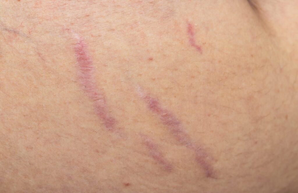 Scarring Portland, OR | Key Laser