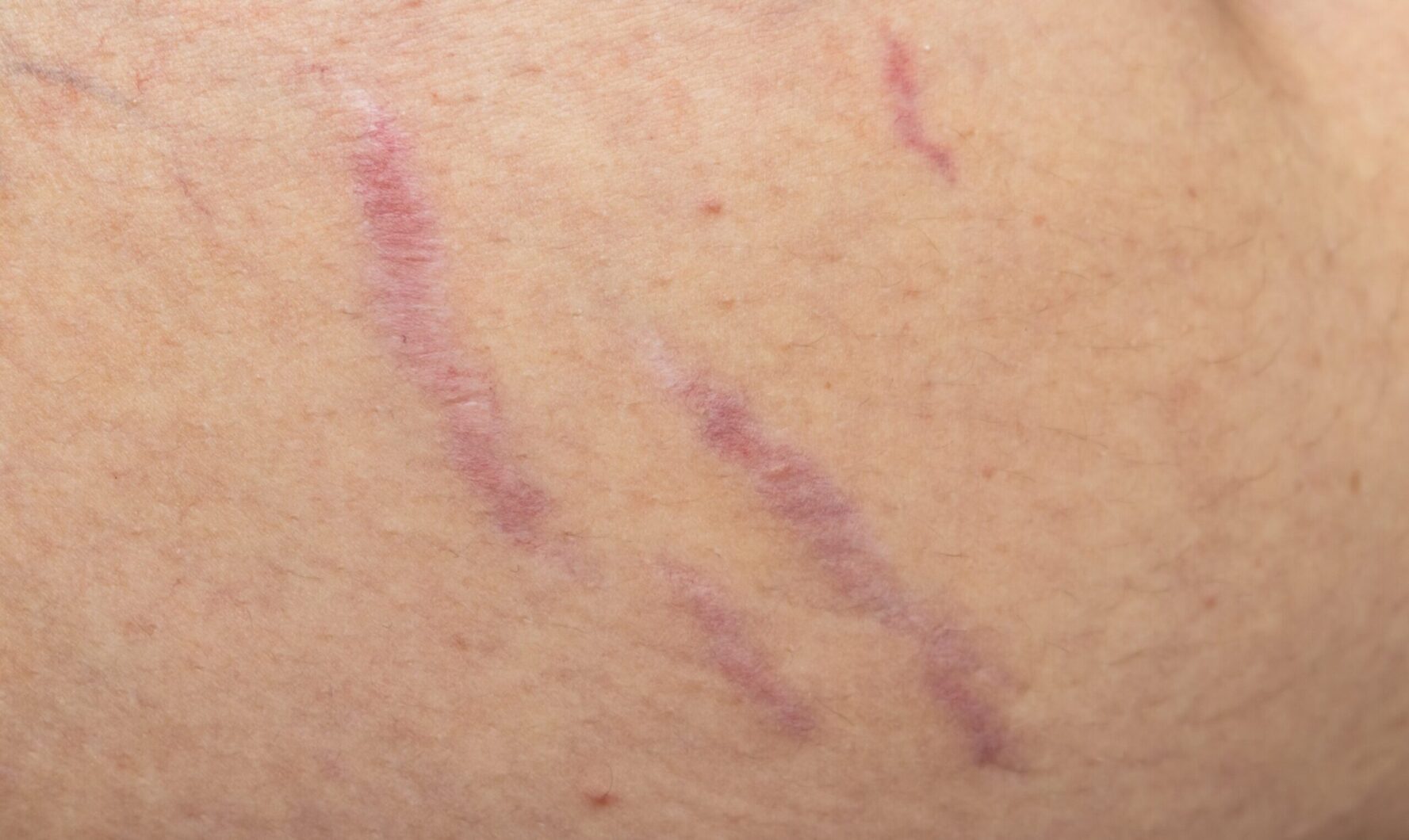 Innovative Laser Scar Removal Treatment in Portland, OR