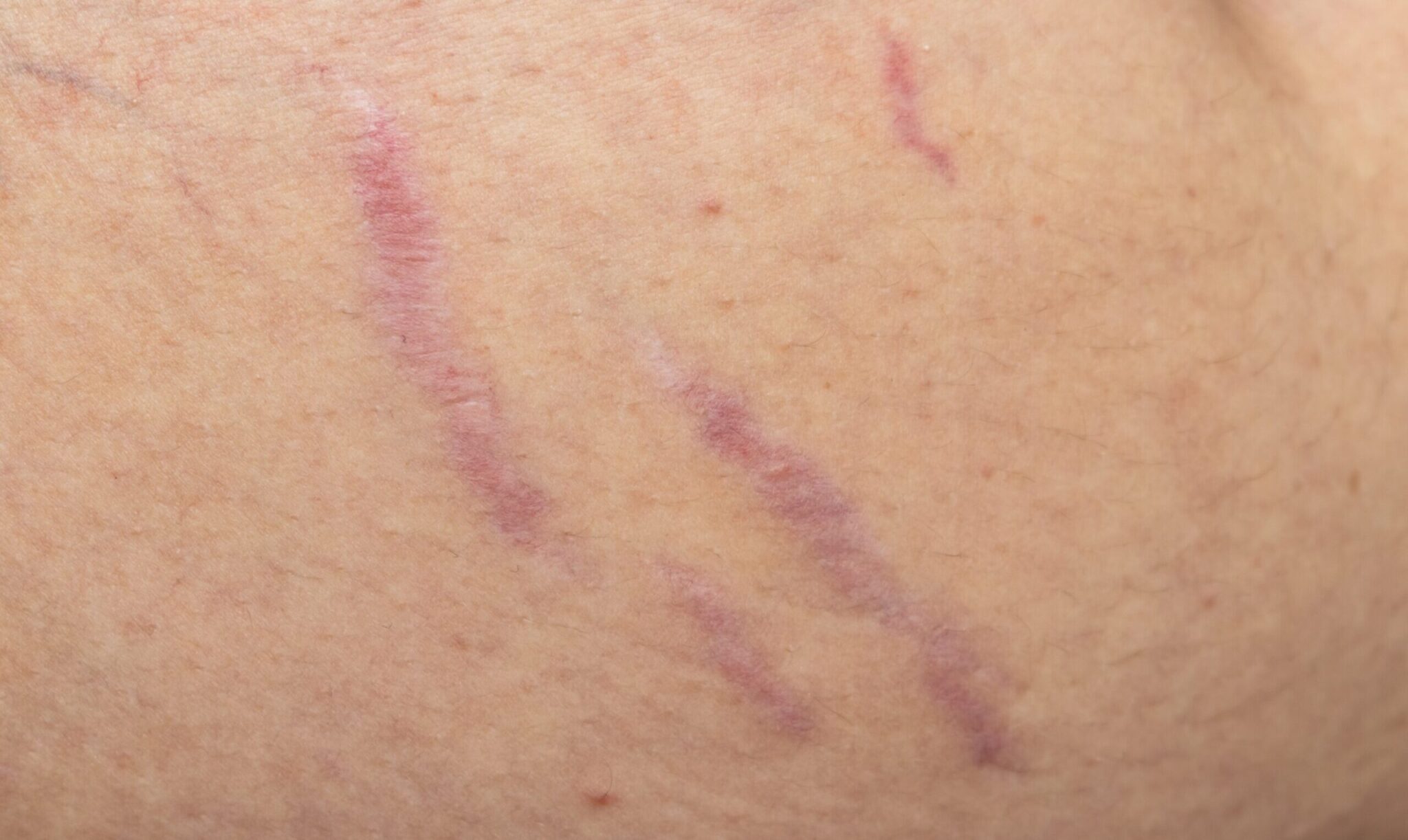 Innovative Laser Scar Removal Treatment in Portland, OR