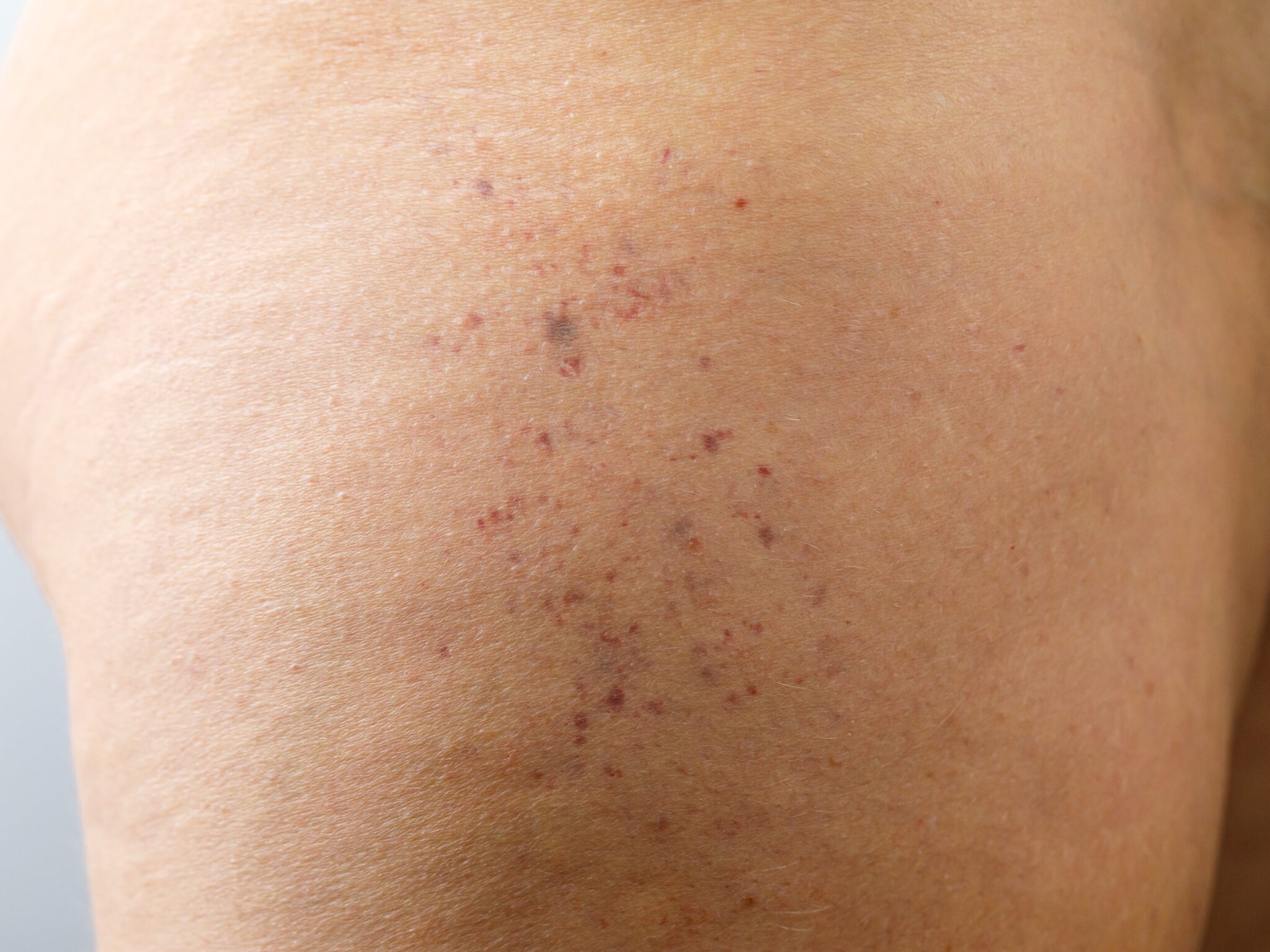 Broken Blood Vessels Treatment in Portland, OR | Key Laser Institute