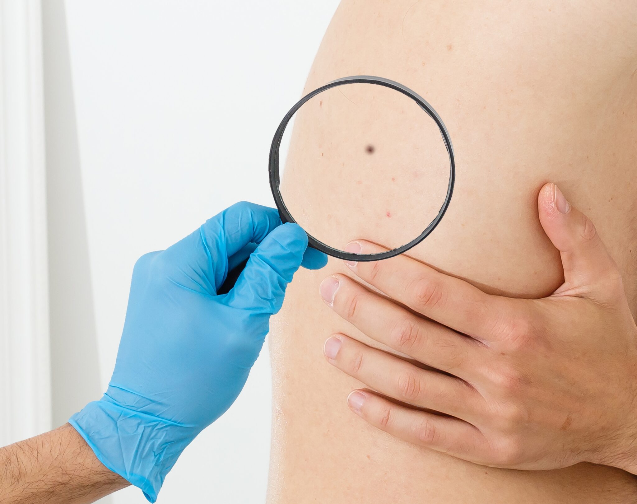 Angiomas Treatment in Portland, OR | Key Laser Institute